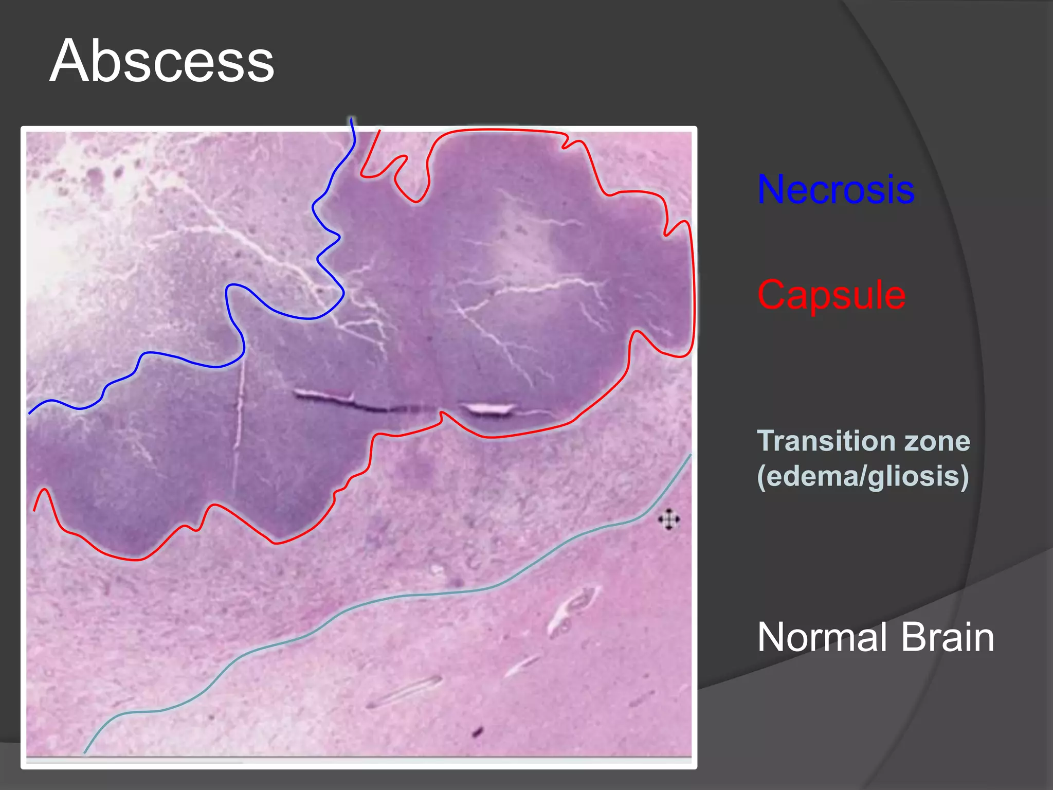 Magnetic resonance features of pyogenic brain abscesses and ...