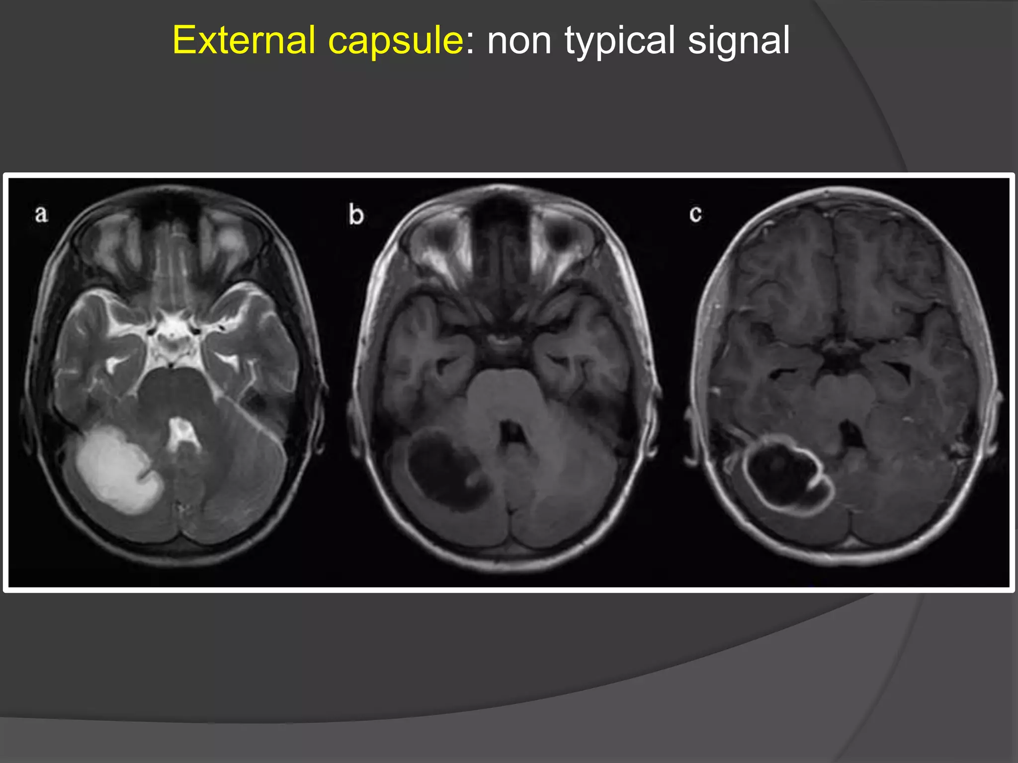 Magnetic resonance features of pyogenic brain abscesses and ...