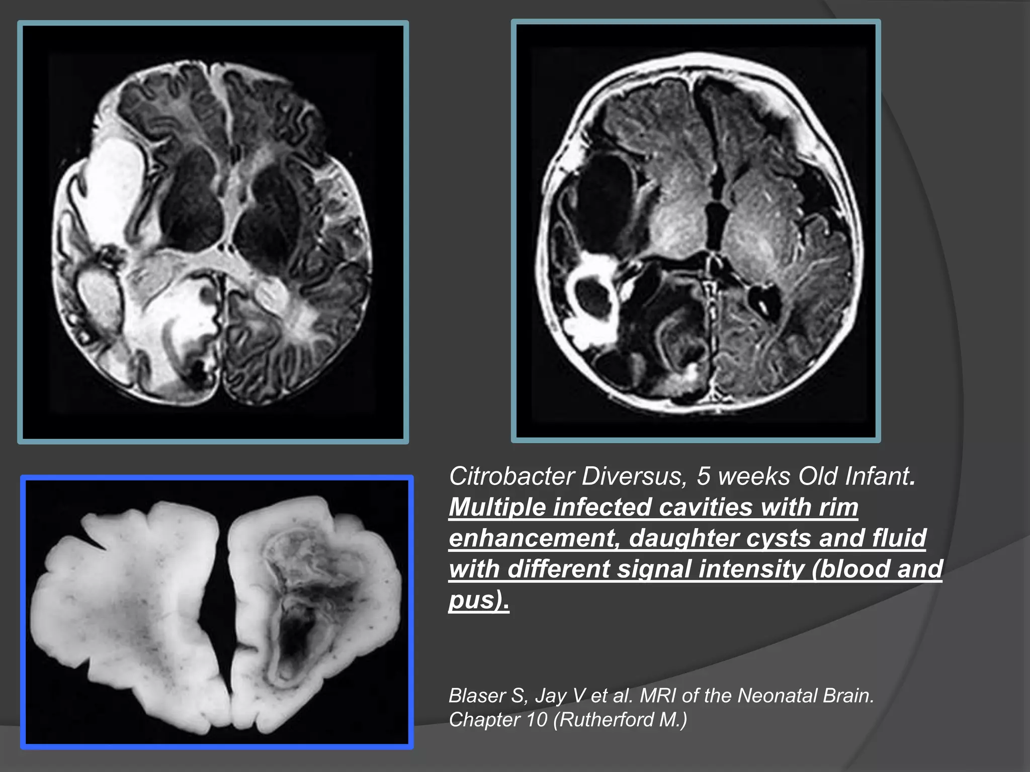Magnetic resonance features of pyogenic brain abscesses and ...