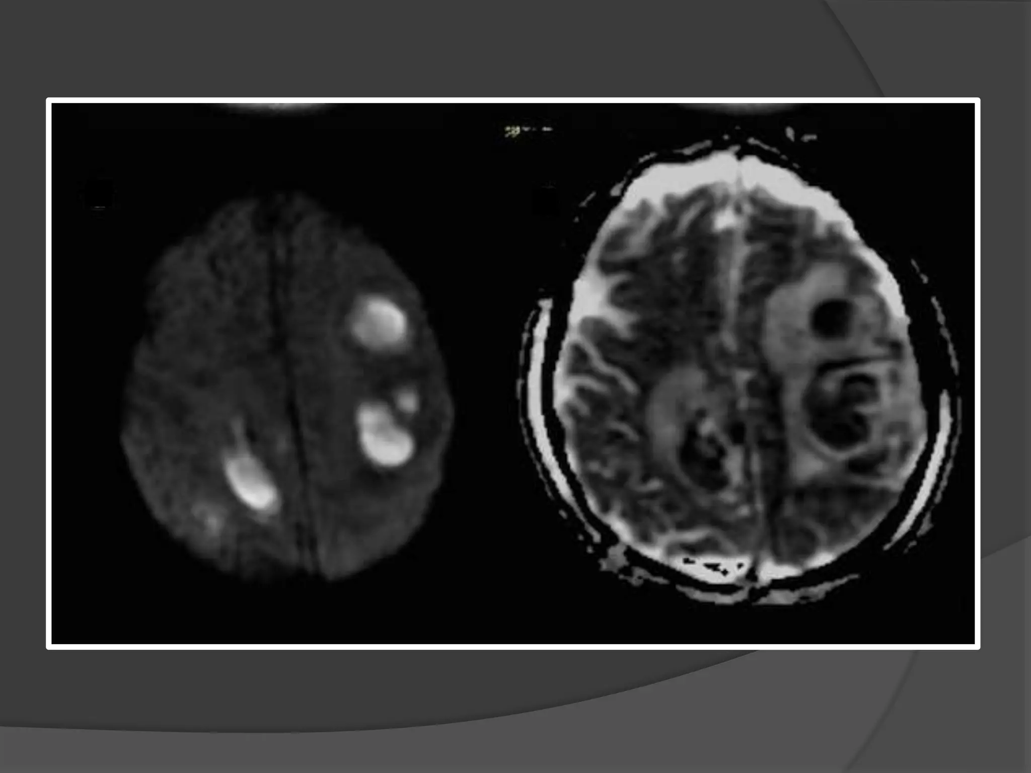 Magnetic resonance features of pyogenic brain abscesses and ...