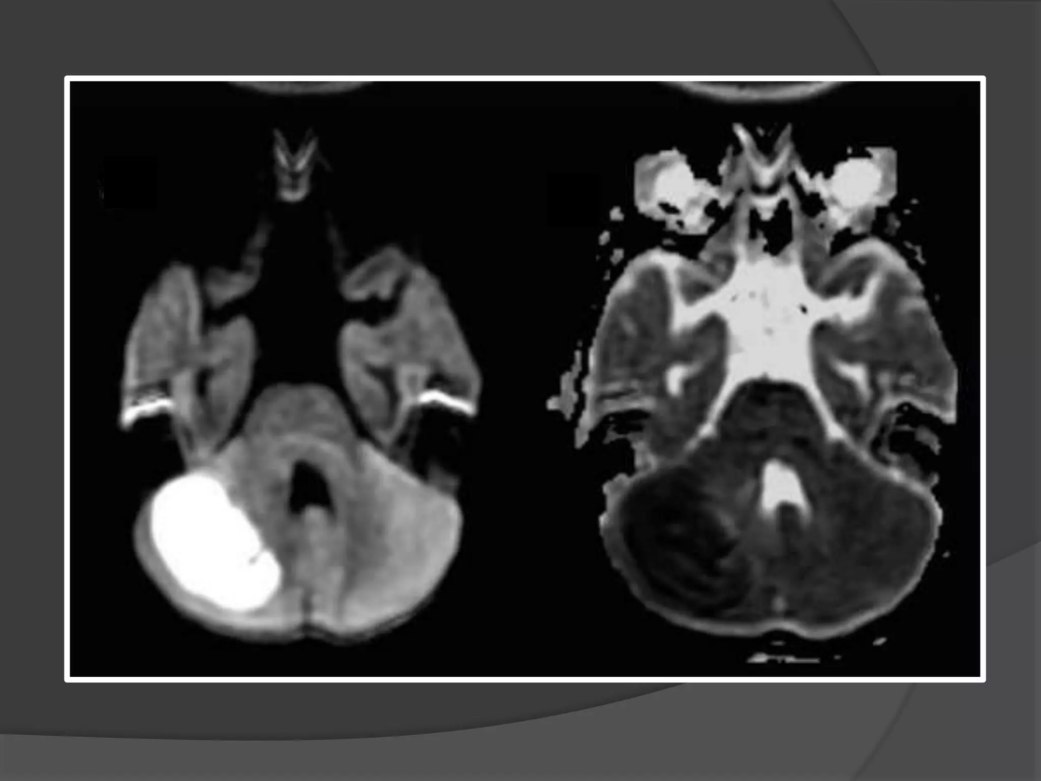 Magnetic resonance features of pyogenic brain abscesses and differential diagnosis using ...