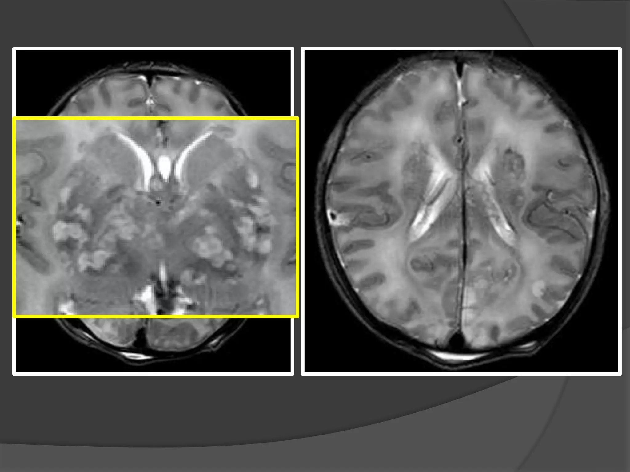 Magnetic resonance features of pyogenic brain abscesses and ...