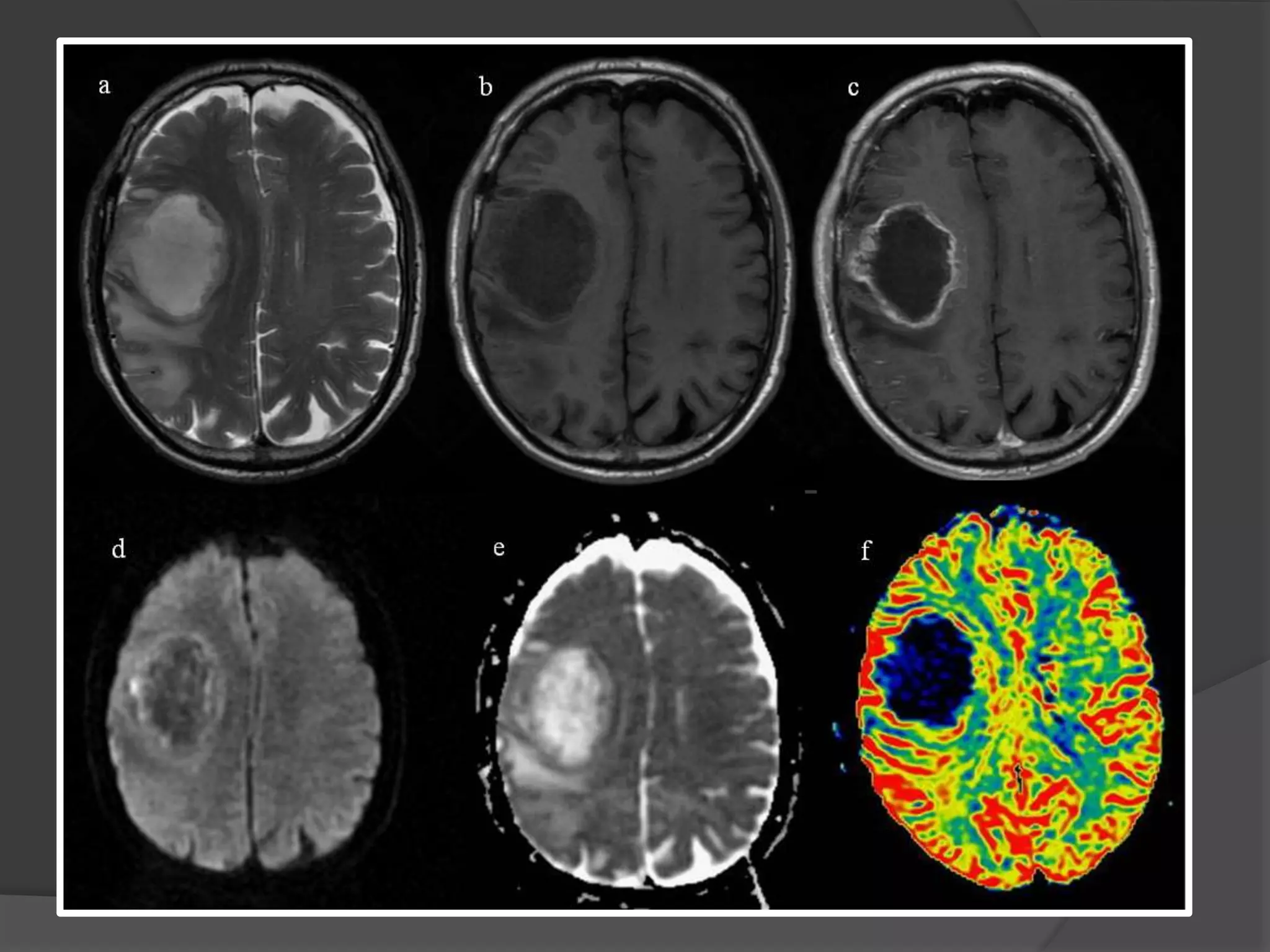 Magnetic resonance features of pyogenic brain abscesses and ...