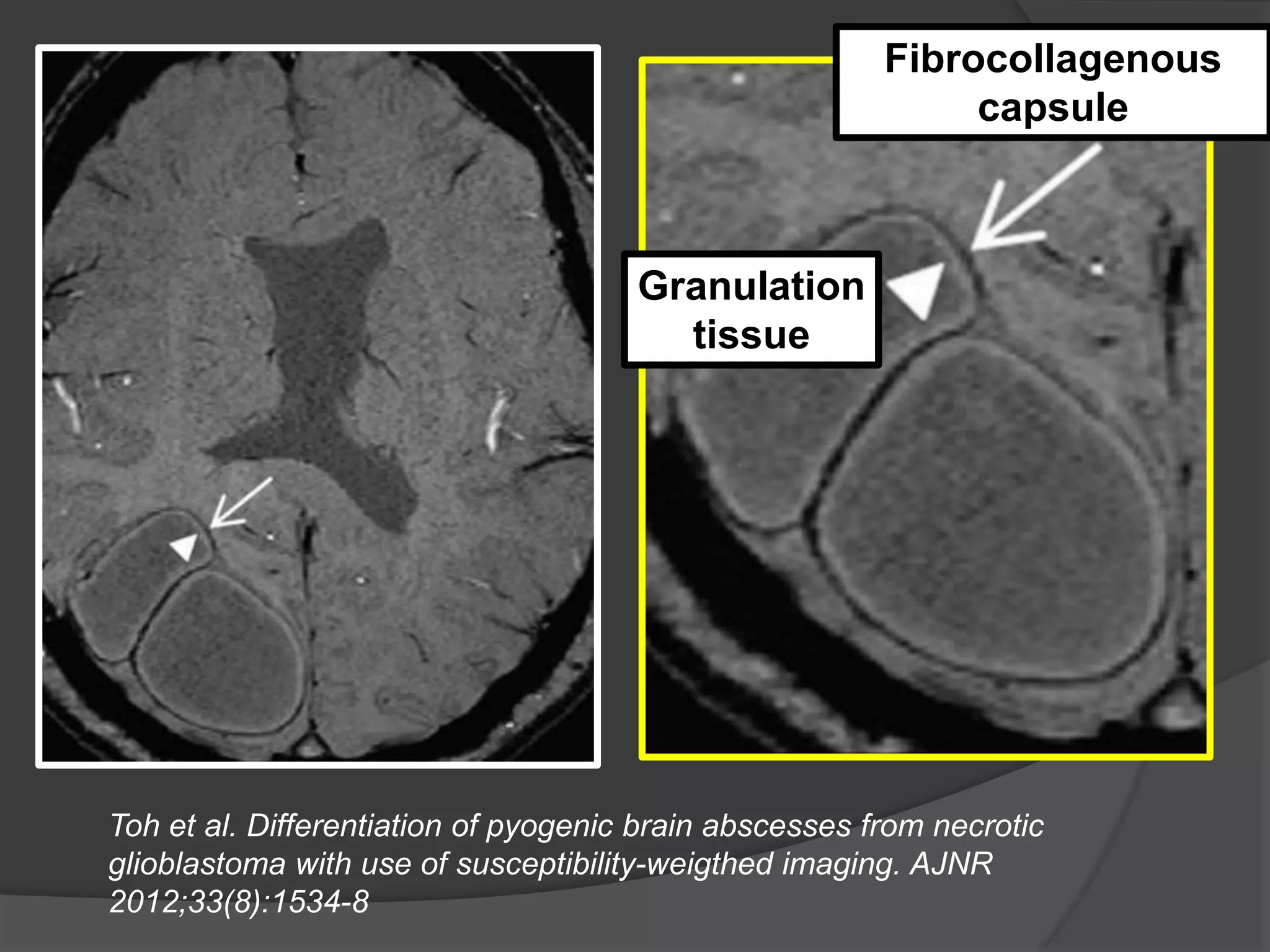 Magnetic resonance features of pyogenic brain abscesses and ...