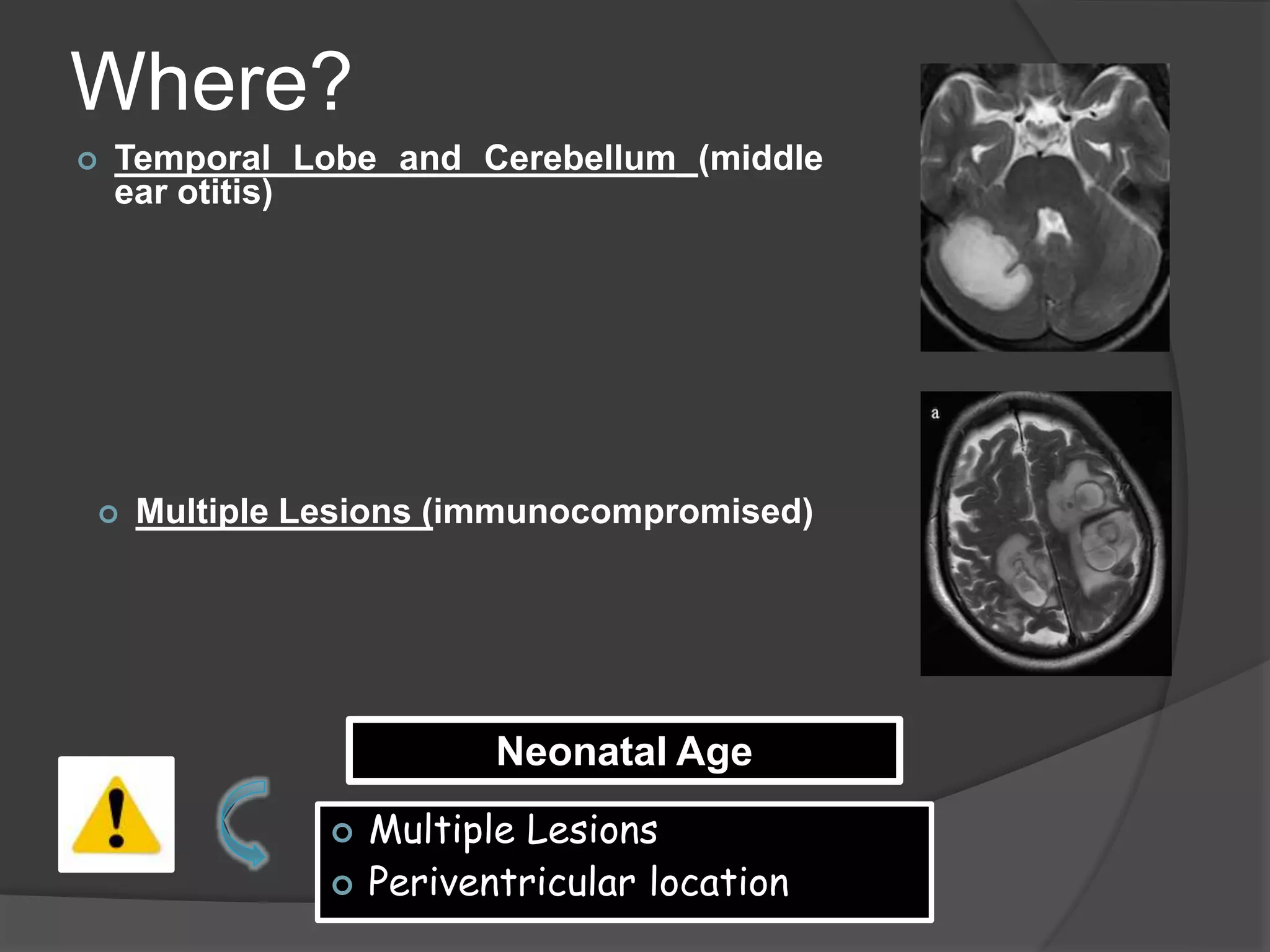 Magnetic resonance features of pyogenic brain abscesses and ...