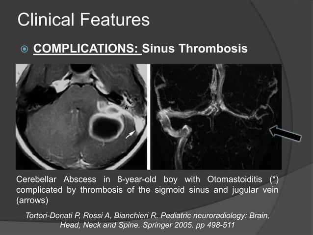 Magnetic resonance features of pyogenic brain abscesses and ...