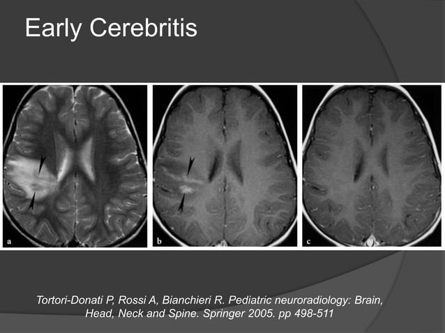Magnetic resonance features of pyogenic brain abscesses and ...