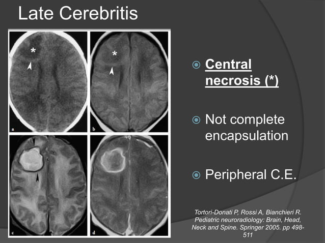 Magnetic resonance features of pyogenic brain abscesses and ...