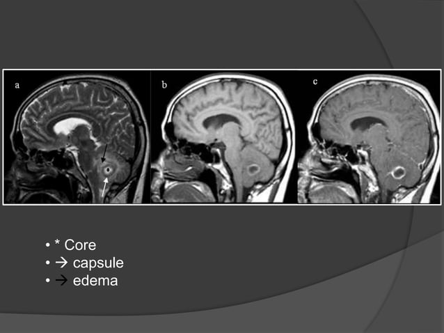 Magnetic resonance features of pyogenic brain abscesses and ...