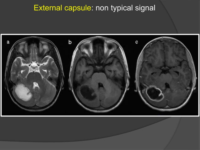 Magnetic resonance features of pyogenic brain abscesses and ...