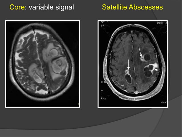 Magnetic resonance features of pyogenic brain abscesses and ...