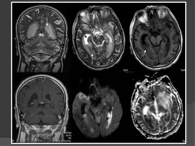 Magnetic resonance features of pyogenic brain abscesses and ...