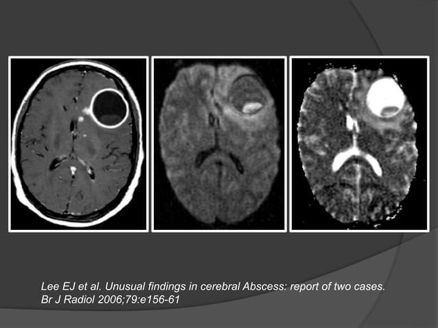 Magnetic resonance features of pyogenic brain abscesses and ...