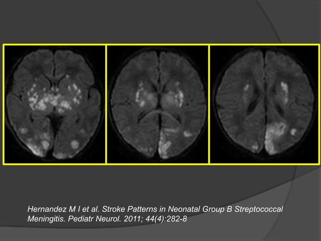 Magnetic resonance features of pyogenic brain abscesses and ...