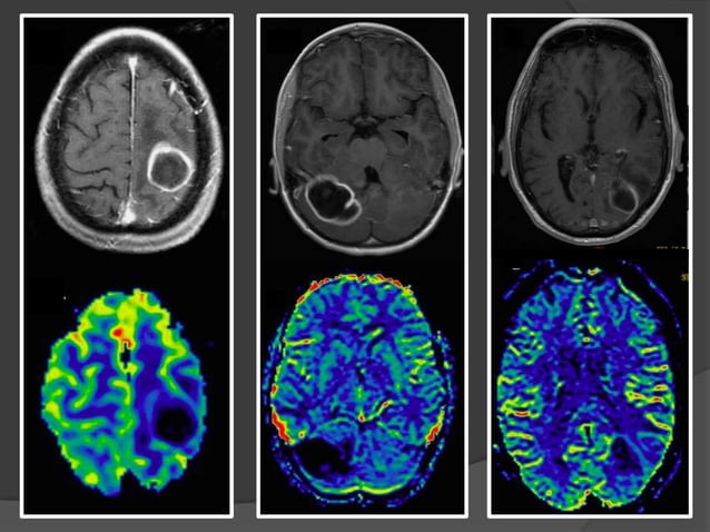 Magnetic resonance features of pyogenic brain abscesses and ...