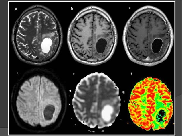 Magnetic resonance features of pyogenic brain abscesses and ...