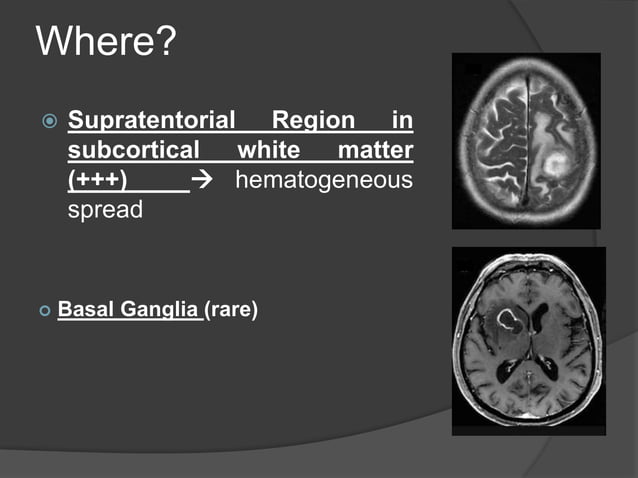 Magnetic resonance features of pyogenic brain abscesses and ...