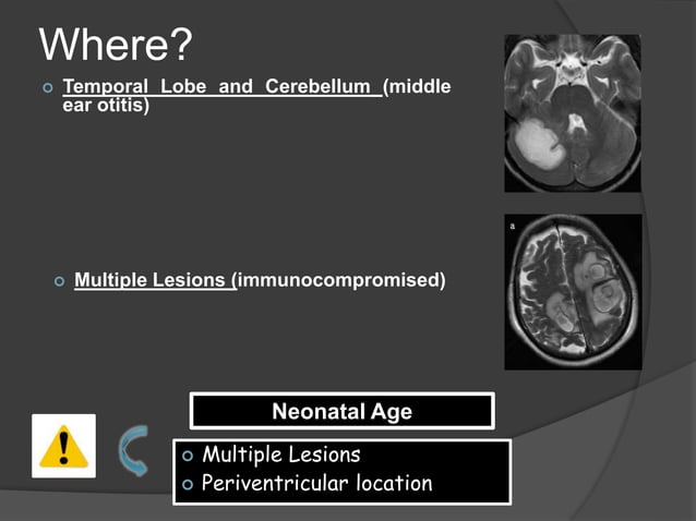Magnetic resonance features of pyogenic brain abscesses and ...