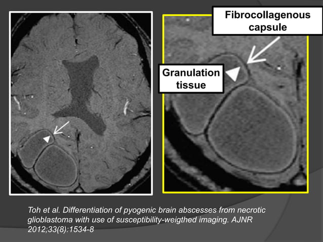 Magnetic resonance features of pyogenic brain abscesses and ...
