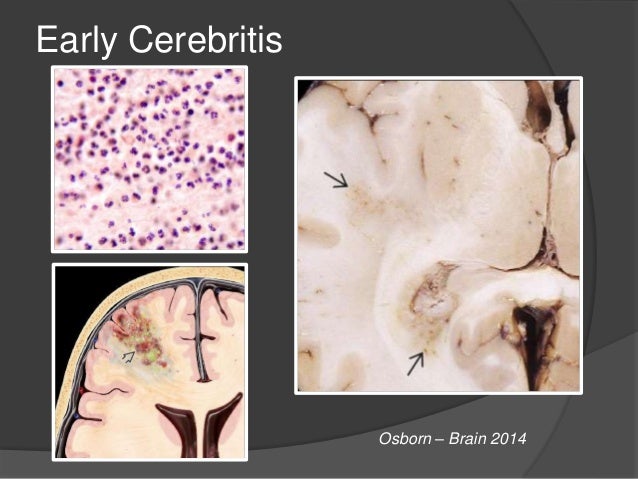 Magnetic resonance features of pyogenic brain abscesses and different…