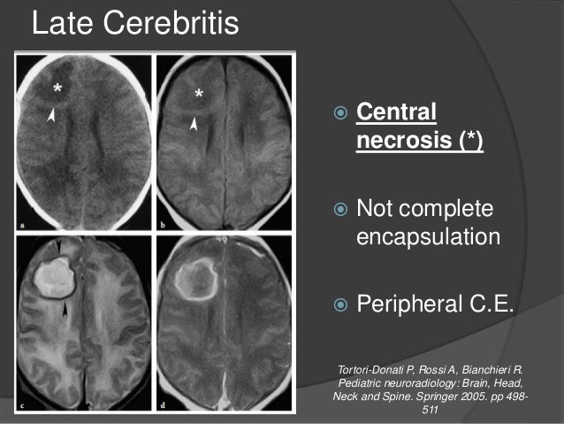 Magnetic resonance features of pyogenic brain abscesses and different…
