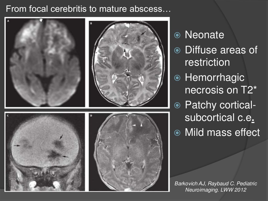Magnetic resonance features of pyogenic brain abscesses and different…