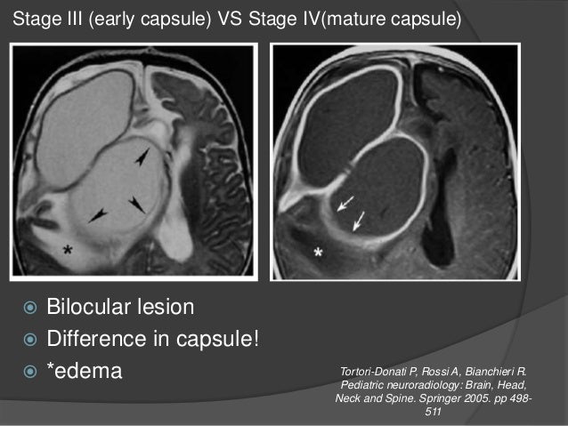 Magnetic resonance features of pyogenic brain abscesses and different…