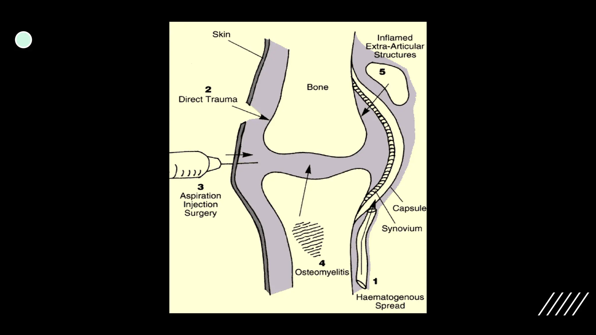 Pyogenic_Arthritis and its management ppt | PPTX