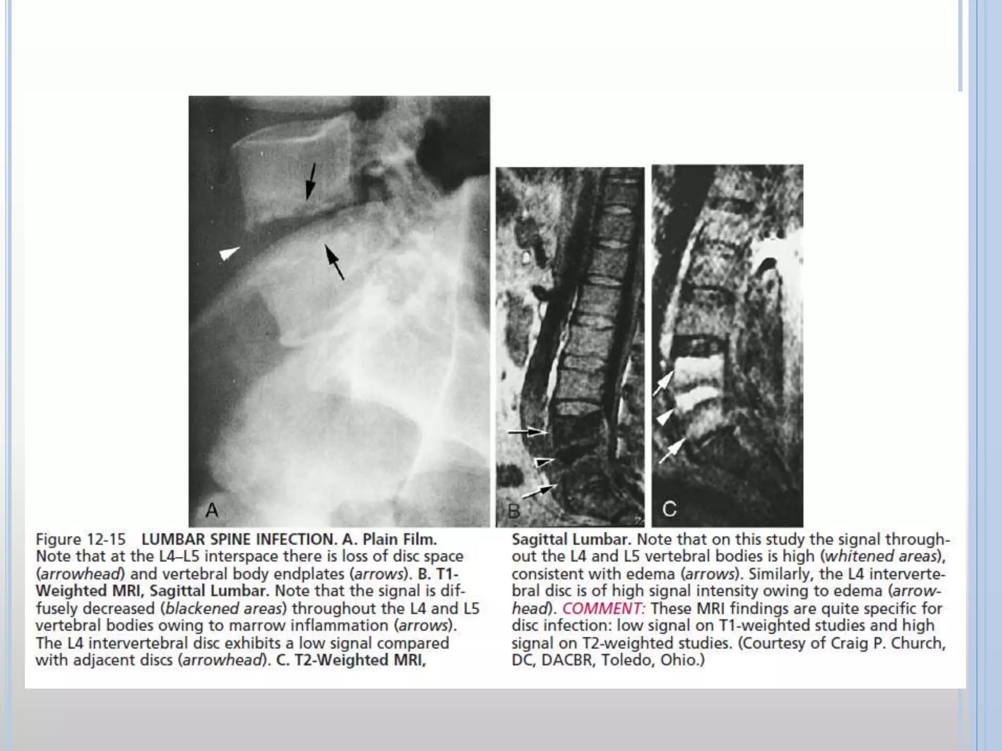 Pyogenic bone and joint infections | PPTX