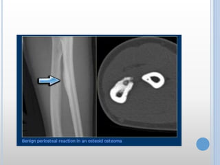 Pyogenic bone and joint infections | PPTX