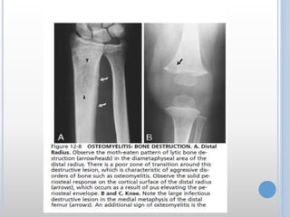 Pyogenic bone and joint infections | PPTX