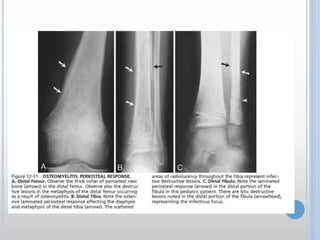 Pyogenic bone and joint infections | PPTX