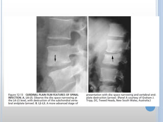 Pyogenic bone and joint infections | PPTX