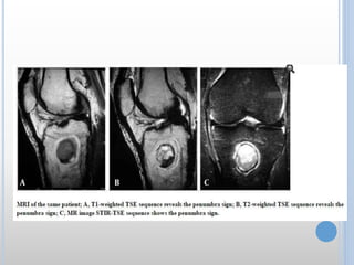 Pyogenic bone and joint infections | PPTX