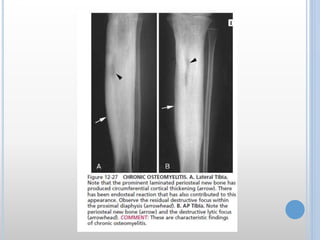 Pyogenic bone and joint infections | PPTX