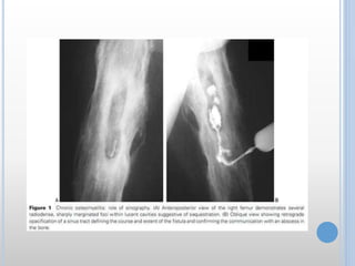 Pyogenic bone and joint infections | PPTX