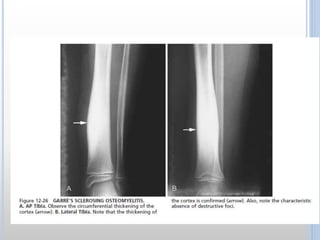 Pyogenic bone and joint infections | PPTX