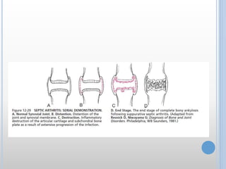 Pyogenic bone and joint infections | PPTX