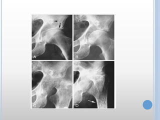 Pyogenic bone and joint infections | PPTX