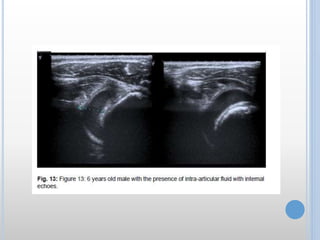 Pyogenic bone and joint infections | PPTX