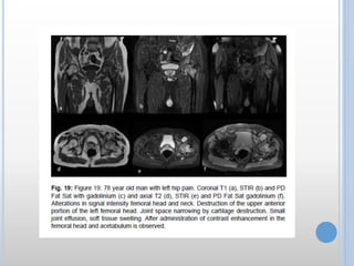 Pyogenic bone and joint infections | PPTX