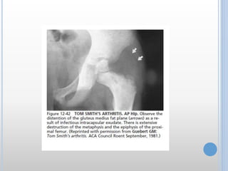 Pyogenic bone and joint infections | PPTX