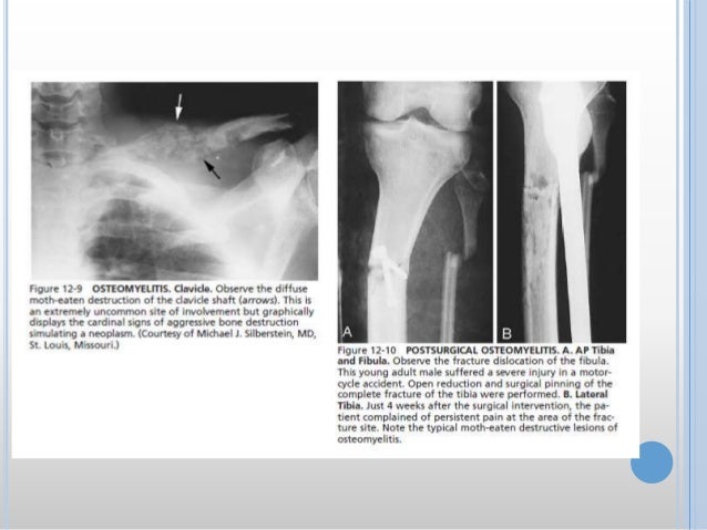 Pyogenic bone and joint infections