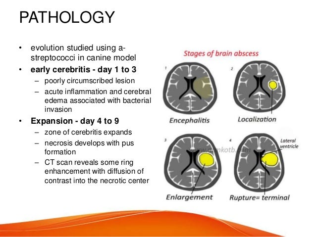 Pyogenic brain abscess