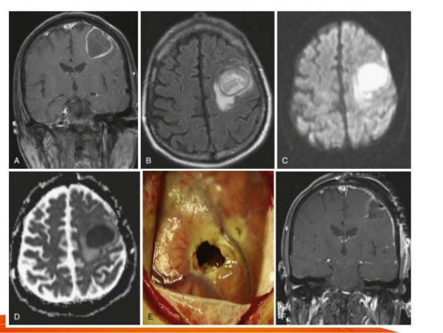 Pyogenic brain abscess