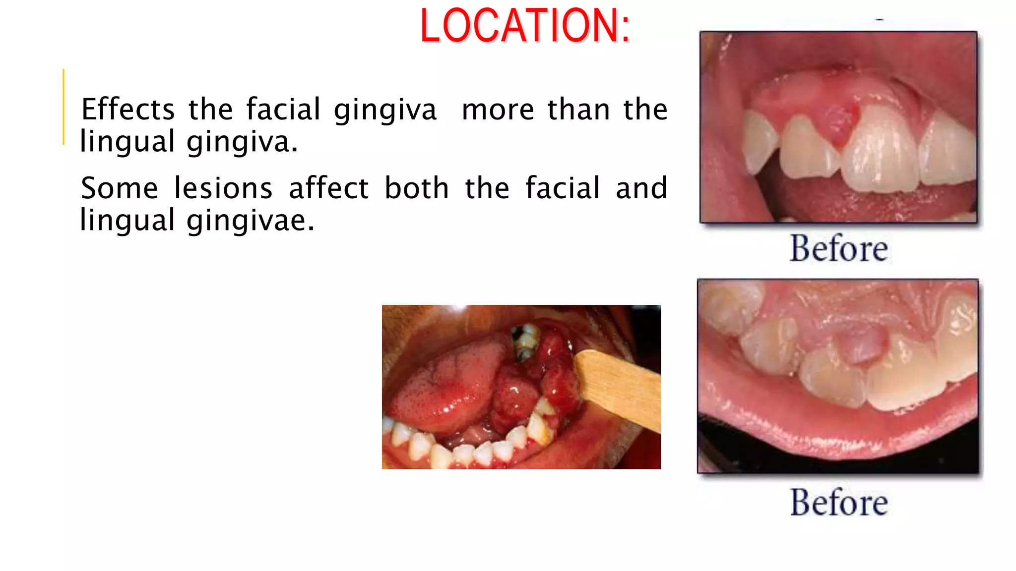 Pyogenic Granuloma | PPTX