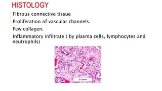 Pyogenic Granuloma | PPTX