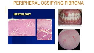 Pyogenic Granuloma | PPTX