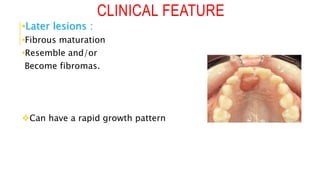 Pyogenic Granuloma | PPTX
