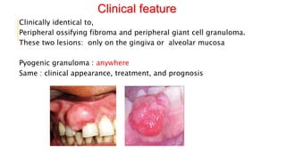 Pyogenic Granuloma | PPTX